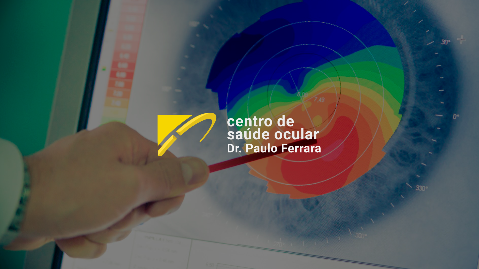 Ceratocone - Centro de Saúde Ocular Dr. Paulo Ferrara - Anel de Ferrara